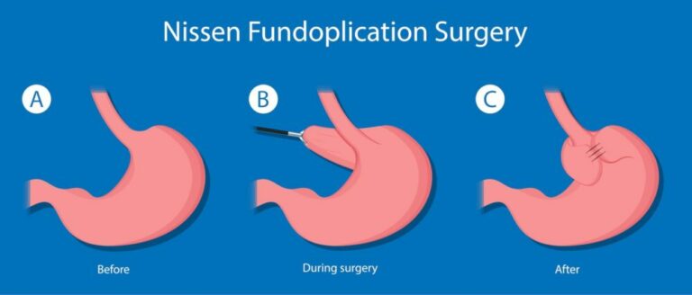 Minimally Invasive Nissen Fundoplication Surgery in DFW